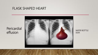 Chest and heart x ray | PPTX
