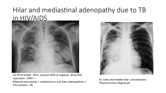 Chest and HIV imaging.jadkakgsGKGKgkukfYUGY | PPTX