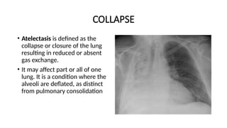 CHEST AND Respiratory SYSTEM, ANATOMY-D1300.pptx