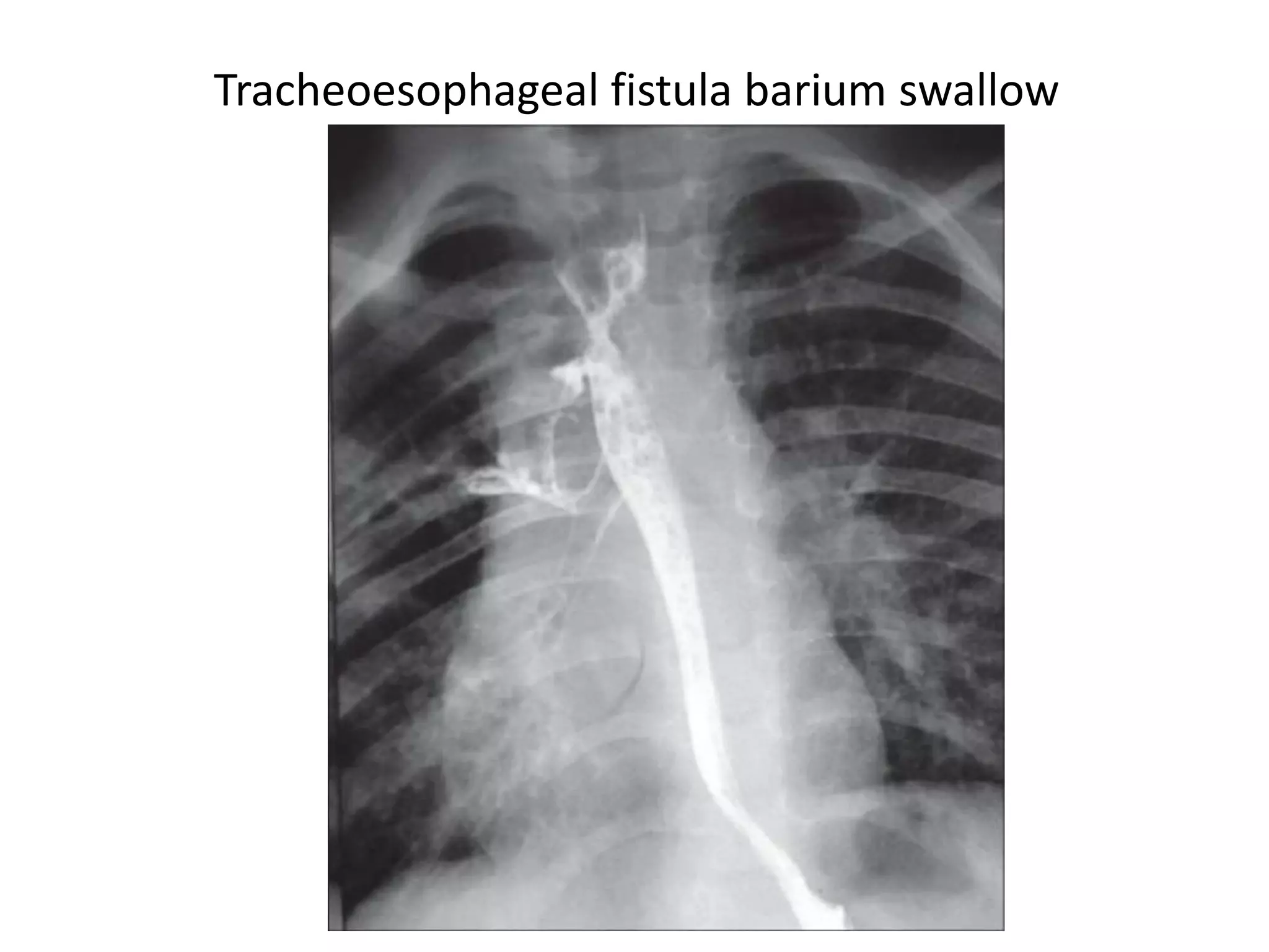 Chest basics + usg dr patil 21818 | PPTX