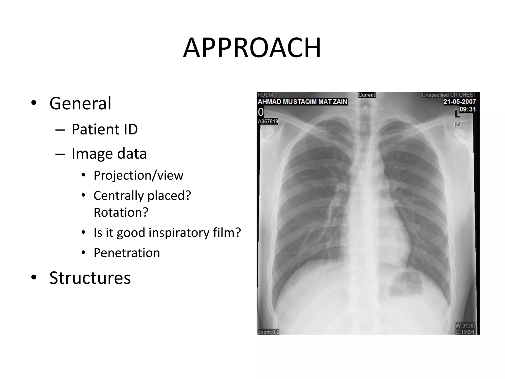 Chest basics + usg dr patil 21818 | PPTX