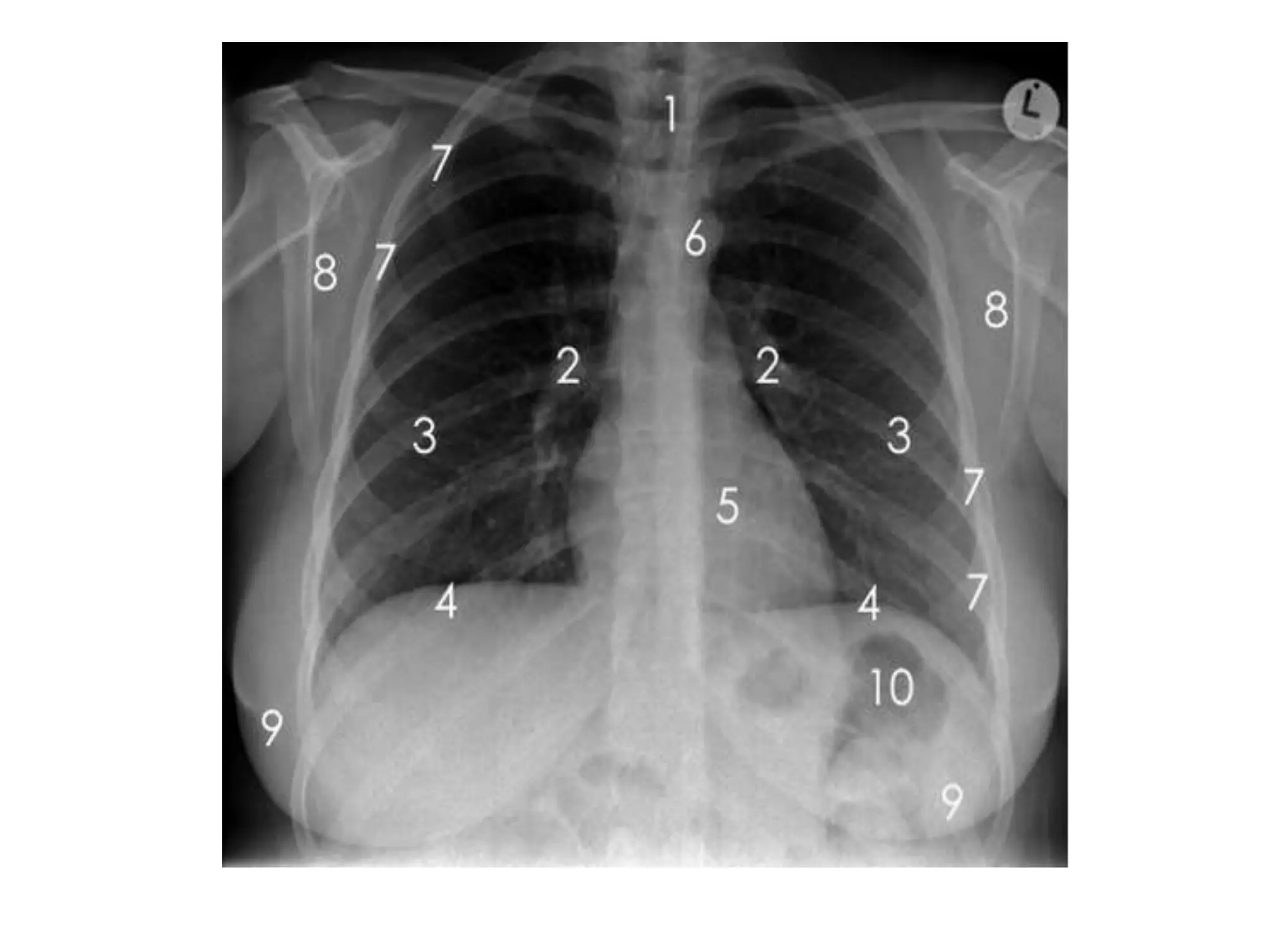 Chest basics + usg dr patil 21818 | PPTX