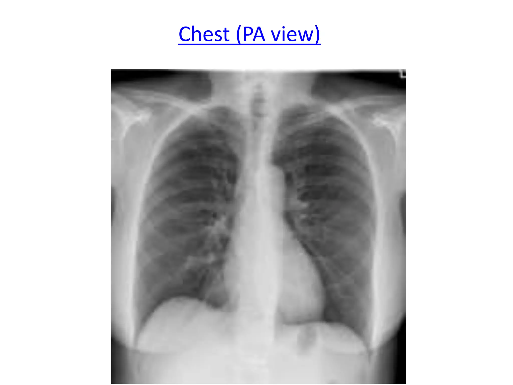 Chest basics + usg dr patil 21818 | PPTX