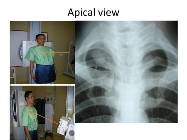 Chest basics + usg dr patil 21818 | PPTX