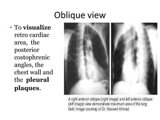 Chest basics + usg dr patil 21818 | PPTX