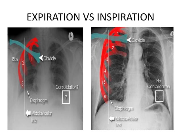 Chest basics + usg dr patil 21818 | PPTX