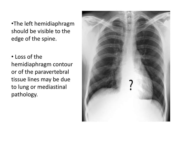 Chest basics + usg dr patil 21818 | PPTX