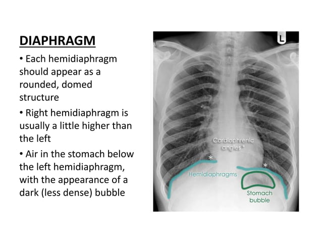 Chest basics + usg dr patil 21818 | PPTX