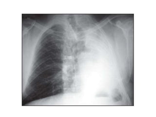Chest basics + usg dr patil 21818 | PPTX
