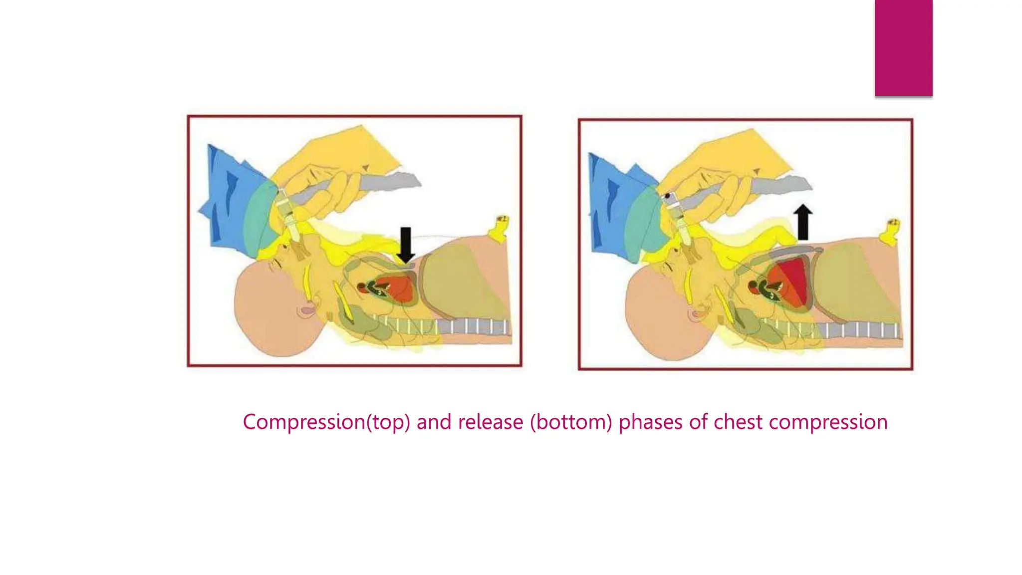 chest compression.pptx