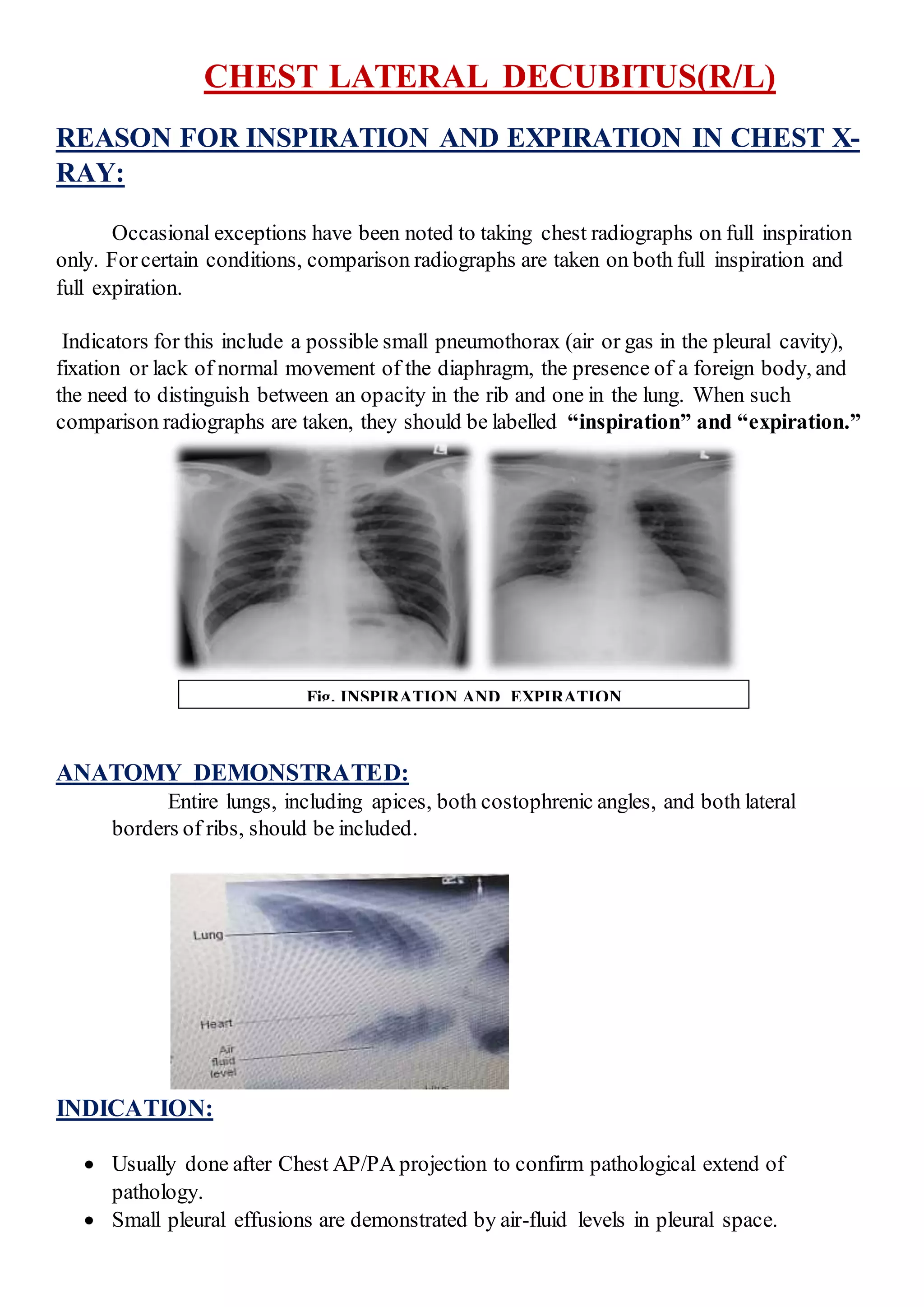 Chest decubitus | DOCX