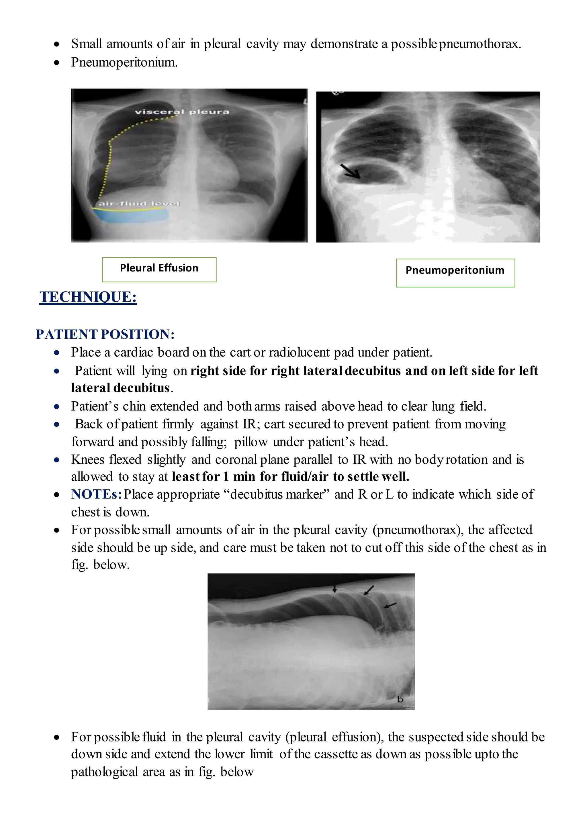 Chest decubitus | DOCX