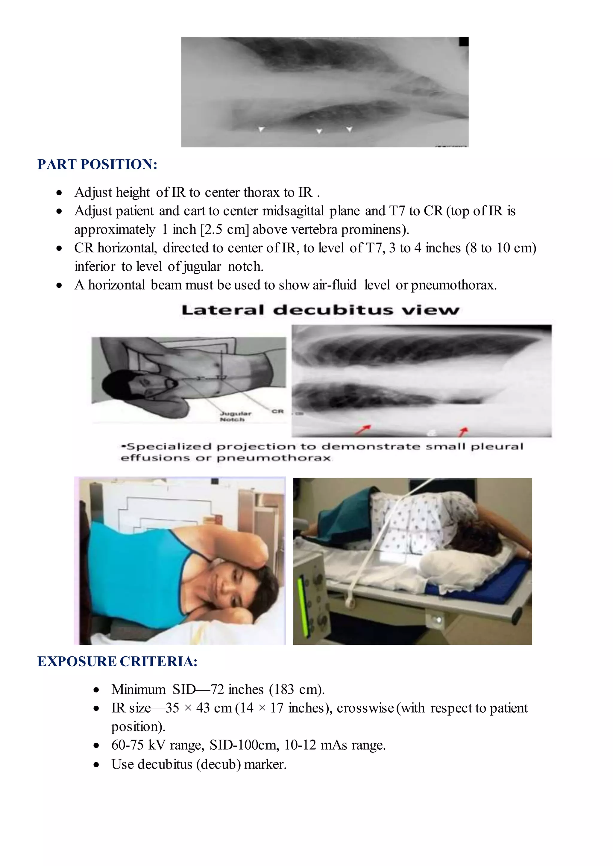Chest decubitus | DOCX
