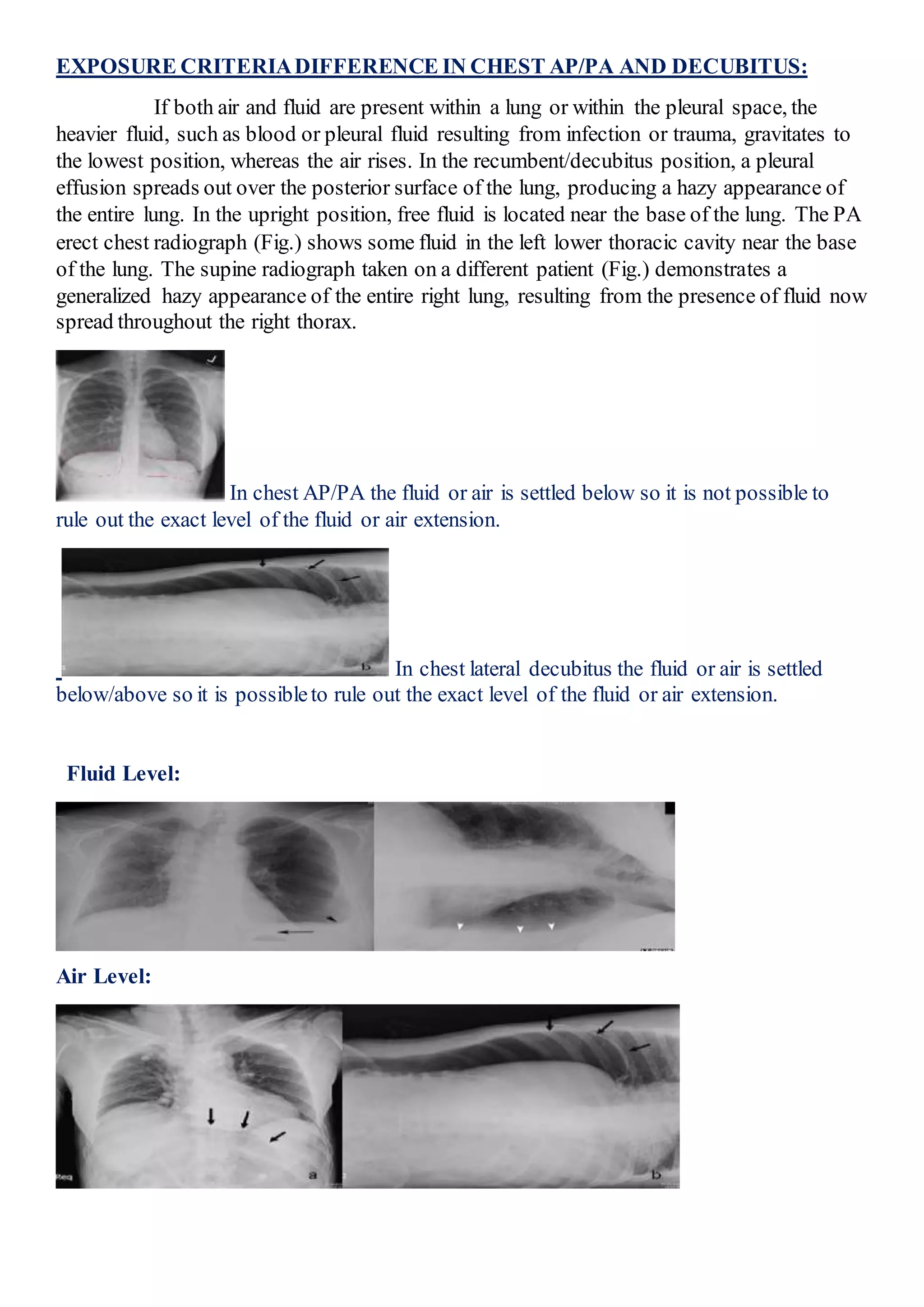 Chest decubitus | DOCX