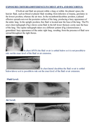 Chest decubitus | DOCX