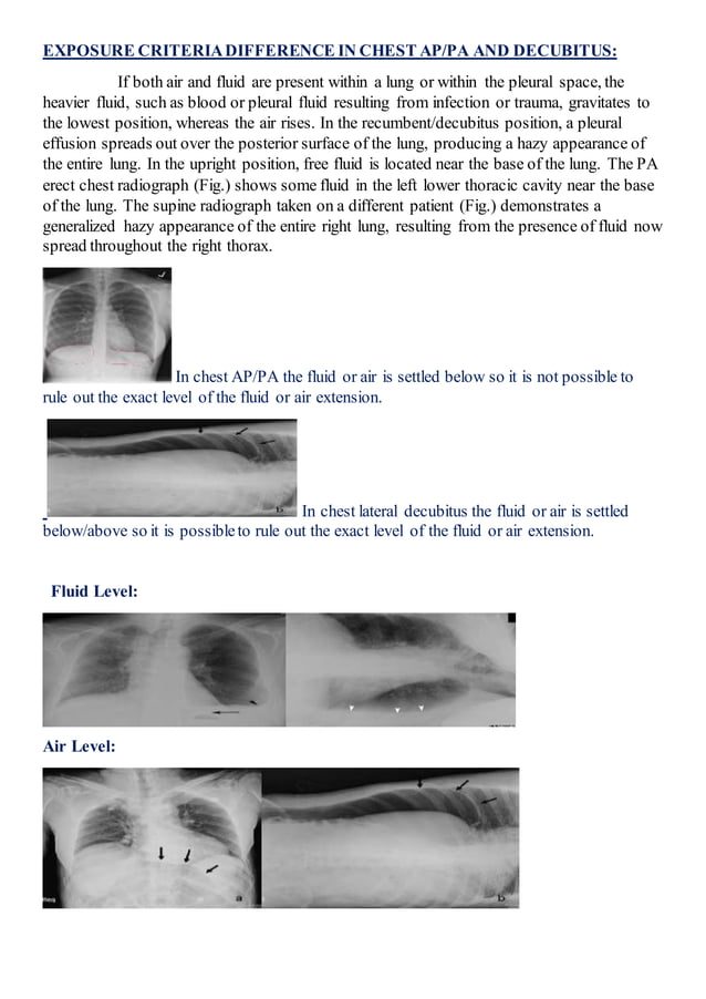 Chest decubitus | DOCX | Lung and Respiratory Health | Diseases and ...