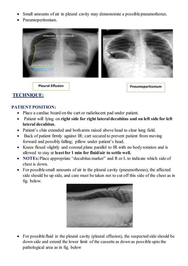Tips And Techniques For Decubitus And Oblique Chest X-Rays – PJLM