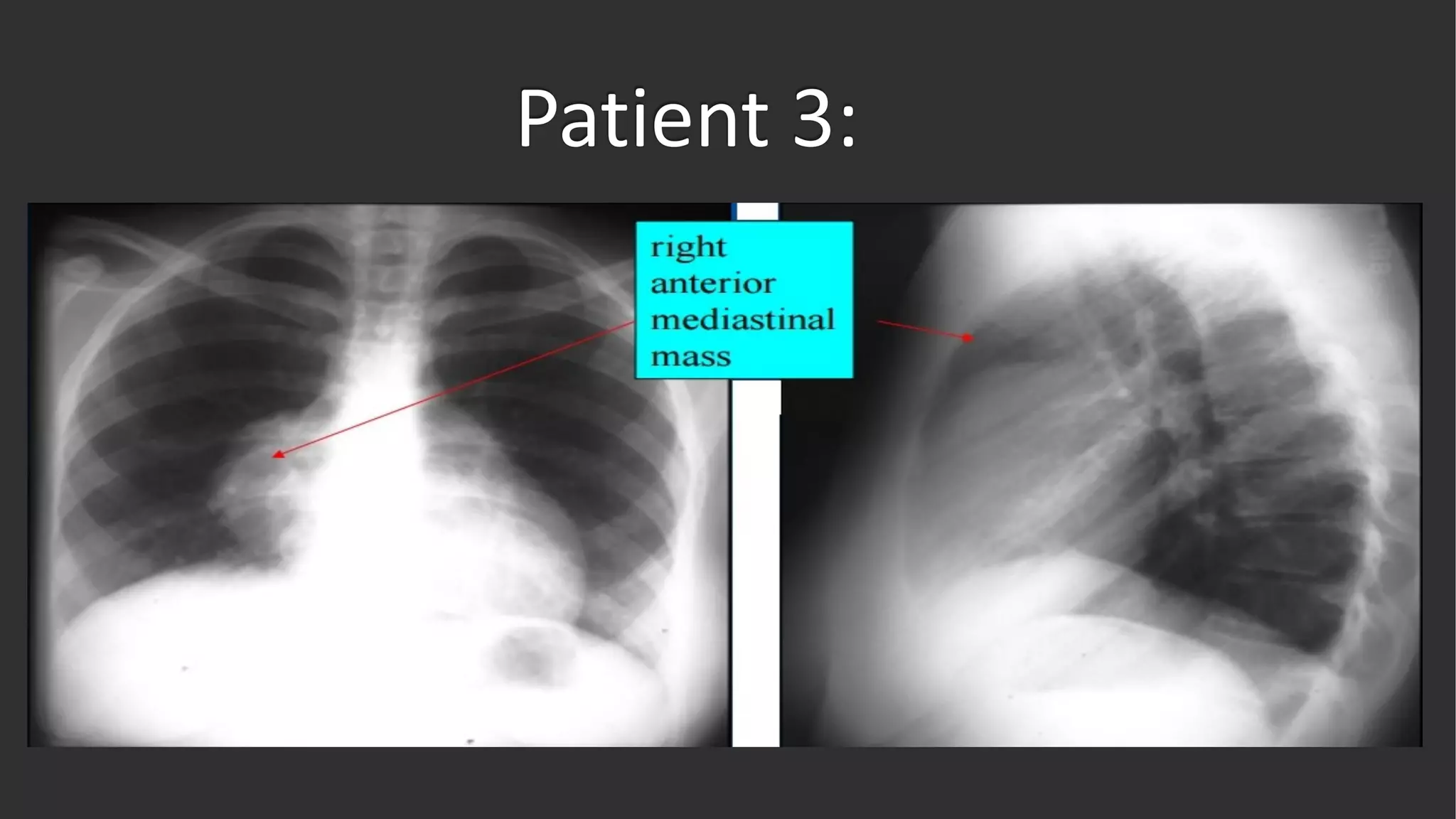 Chest diseases | PPT