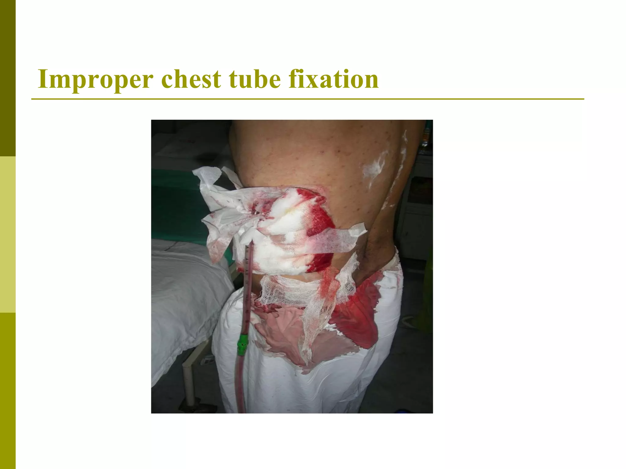 Chest Drains | PPT