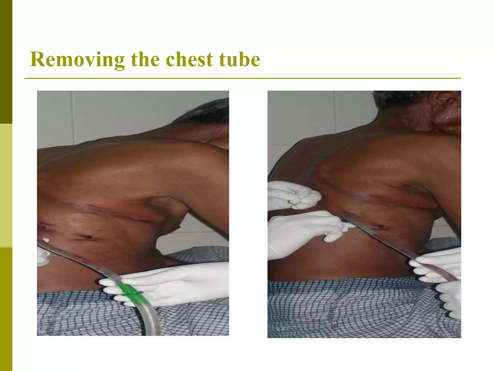 Chest Drains | PPT