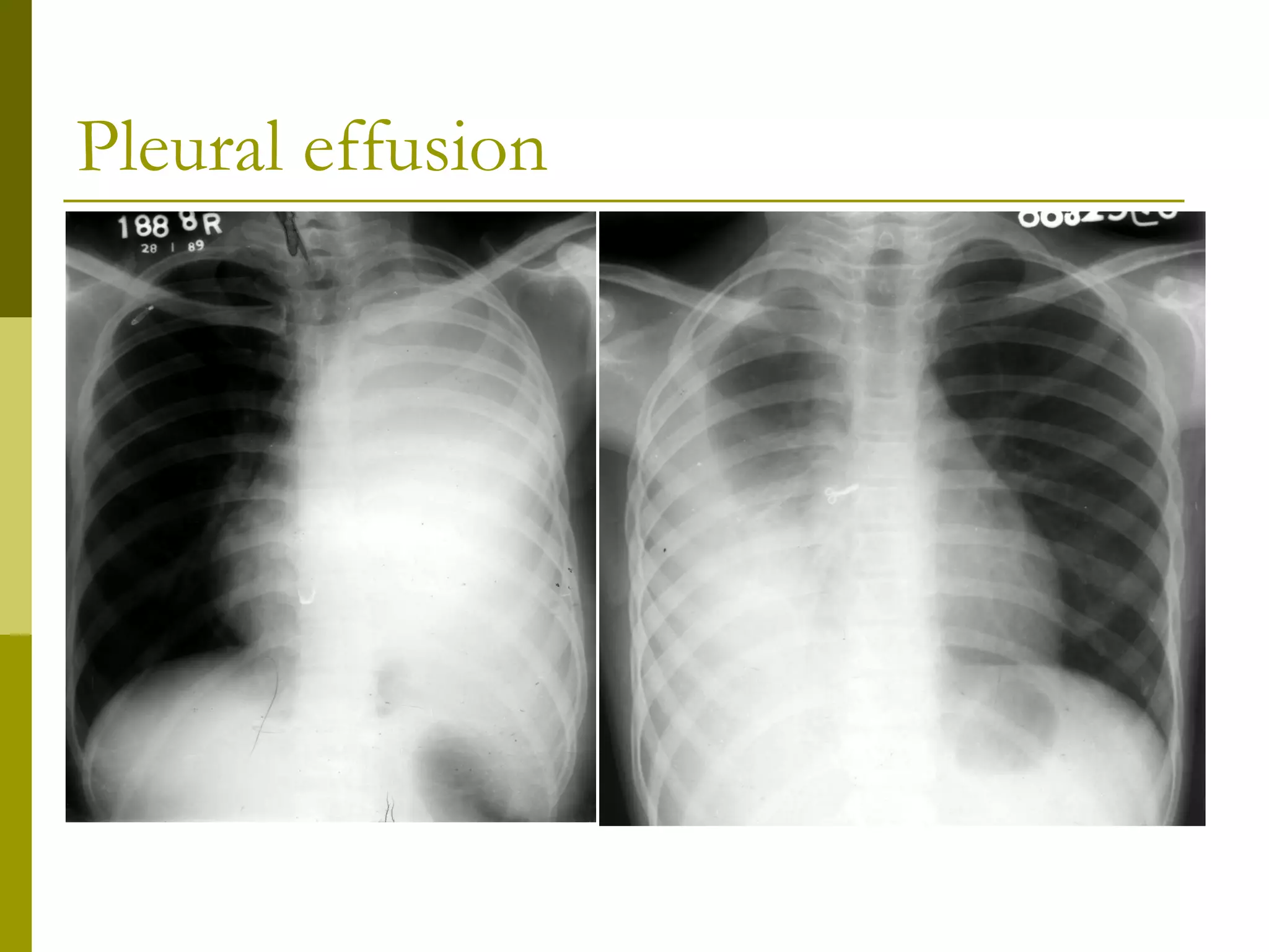 Chest Drains | PPT
