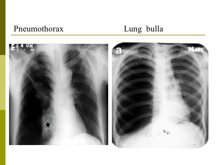 Normal Chest Tube Drainage