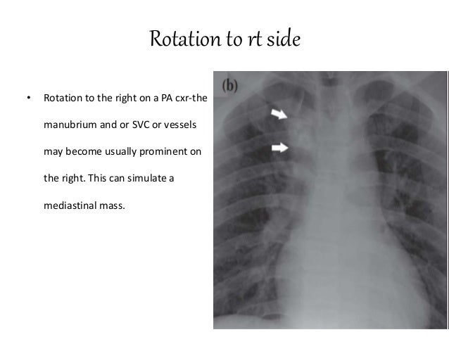 Chest imaging