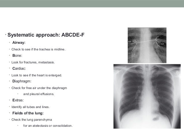 Heart Failure Chest X Ray Abcde Heart Failure Chest X Ray Abcde