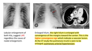 chest imaging lecture 2 in radiology.pdf