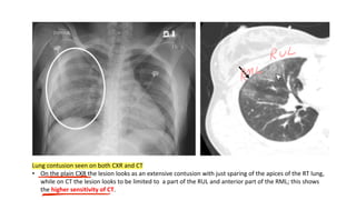 chest imaging lecture 2 in radiology.pdf