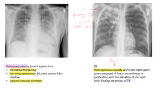 chest imaging lecture 2 in radiology.pdf
