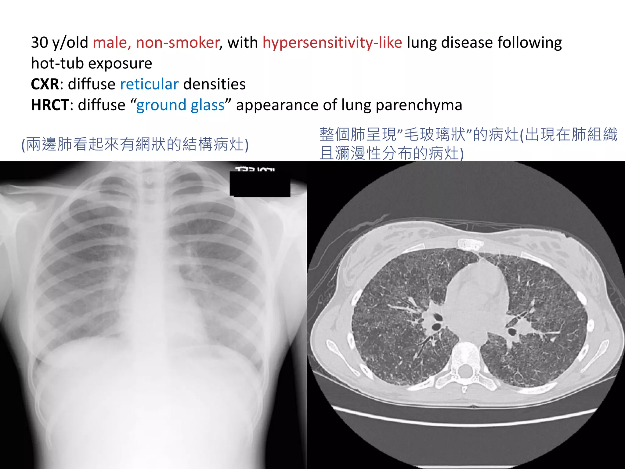 Chest imaging of ntm pulmonary disease2 | PDF