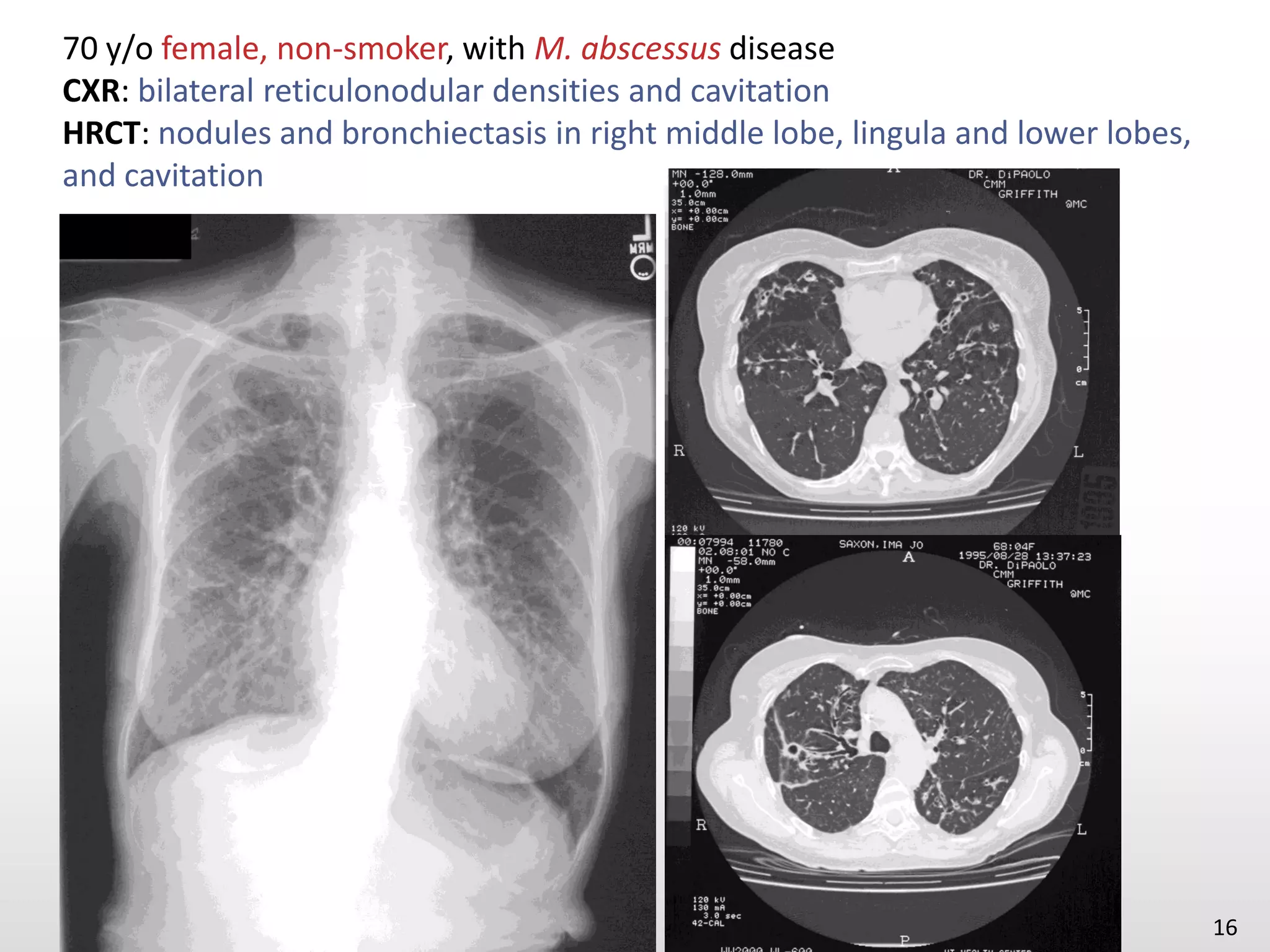 Chest imaging of ntm pulmonary disease2 | PPT