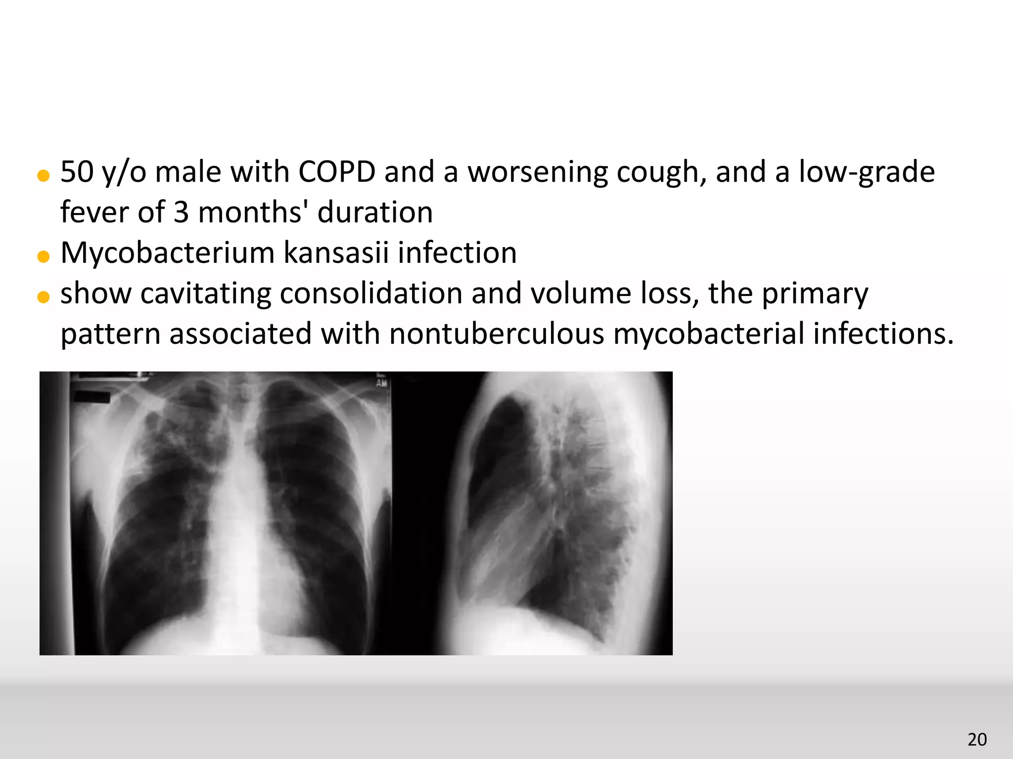 Chest imaging of ntm pulmonary disease2 | PDF