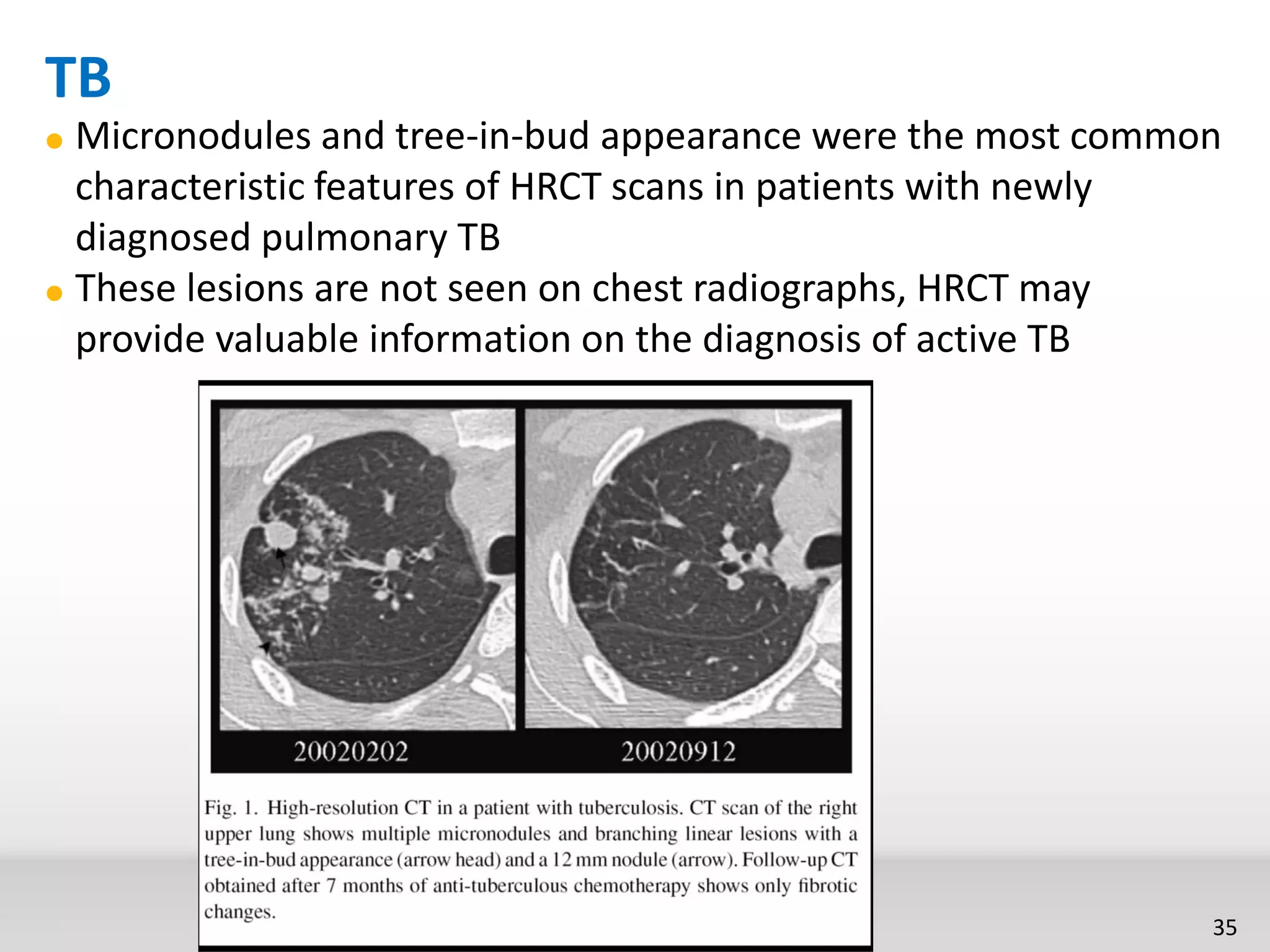 Chest imaging of ntm pulmonary disease2 | PDF