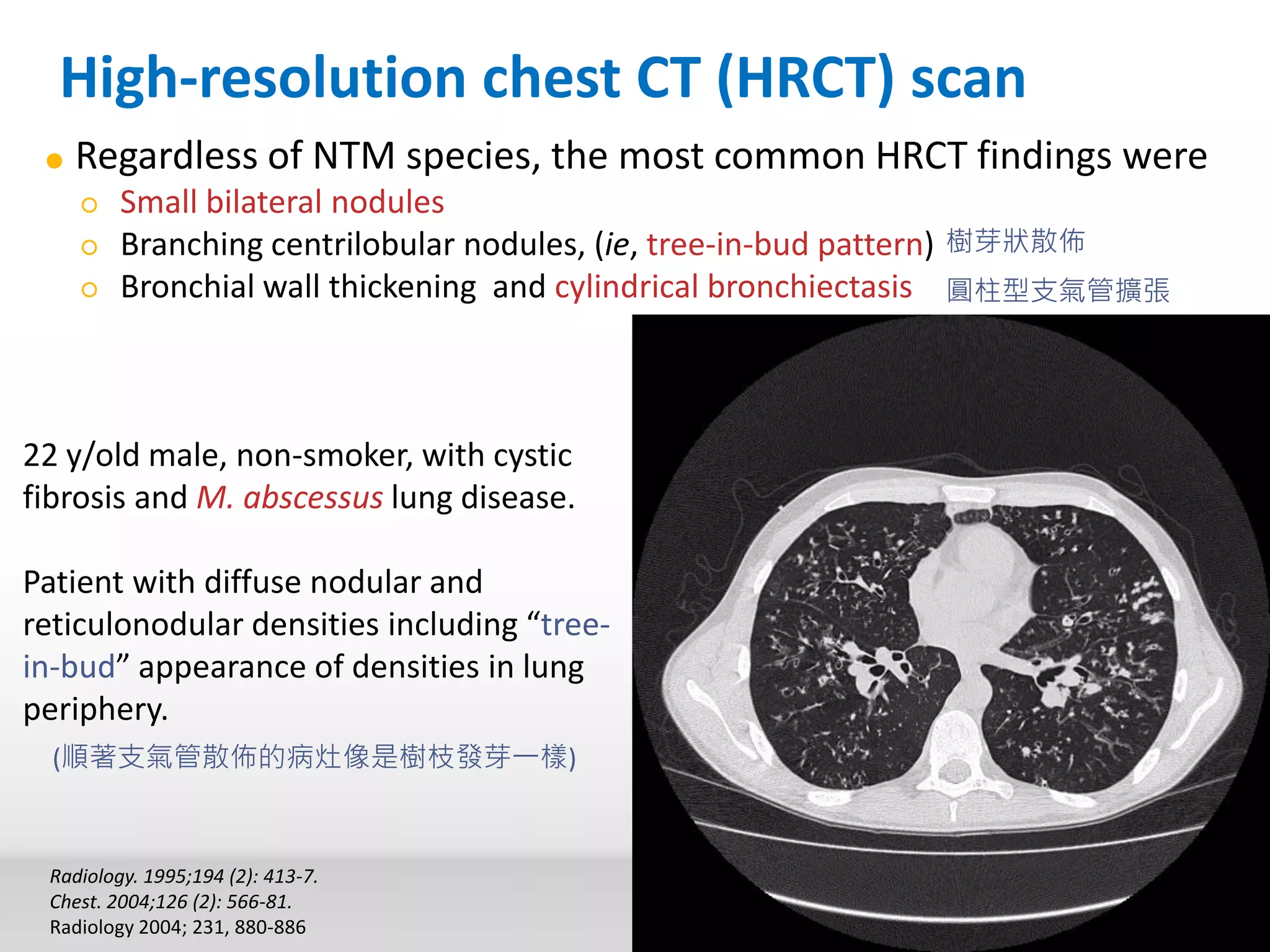 Chest imaging of ntm pulmonary disease2 | PDF