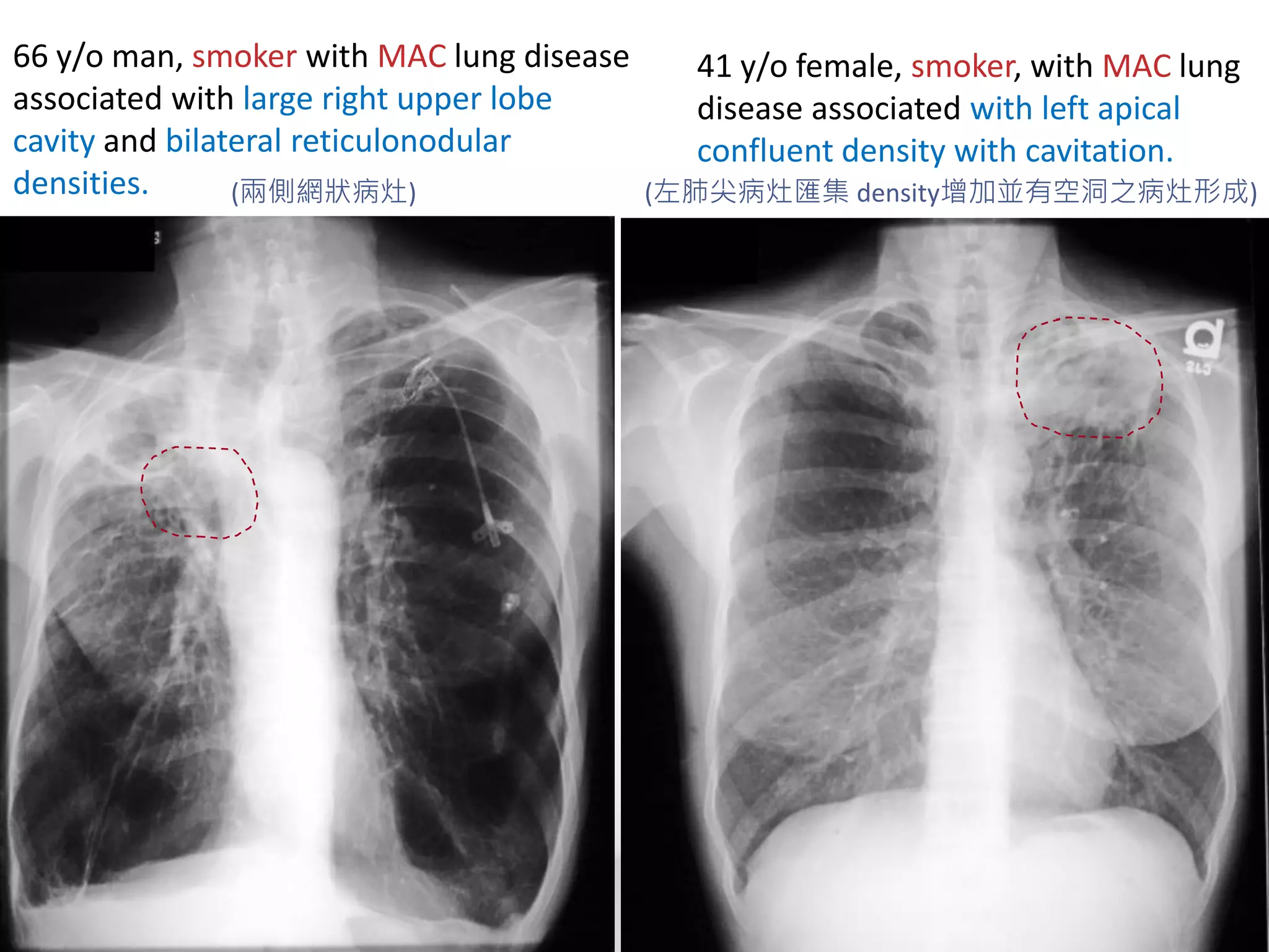 Chest imaging of ntm pulmonary disease2 | PDF