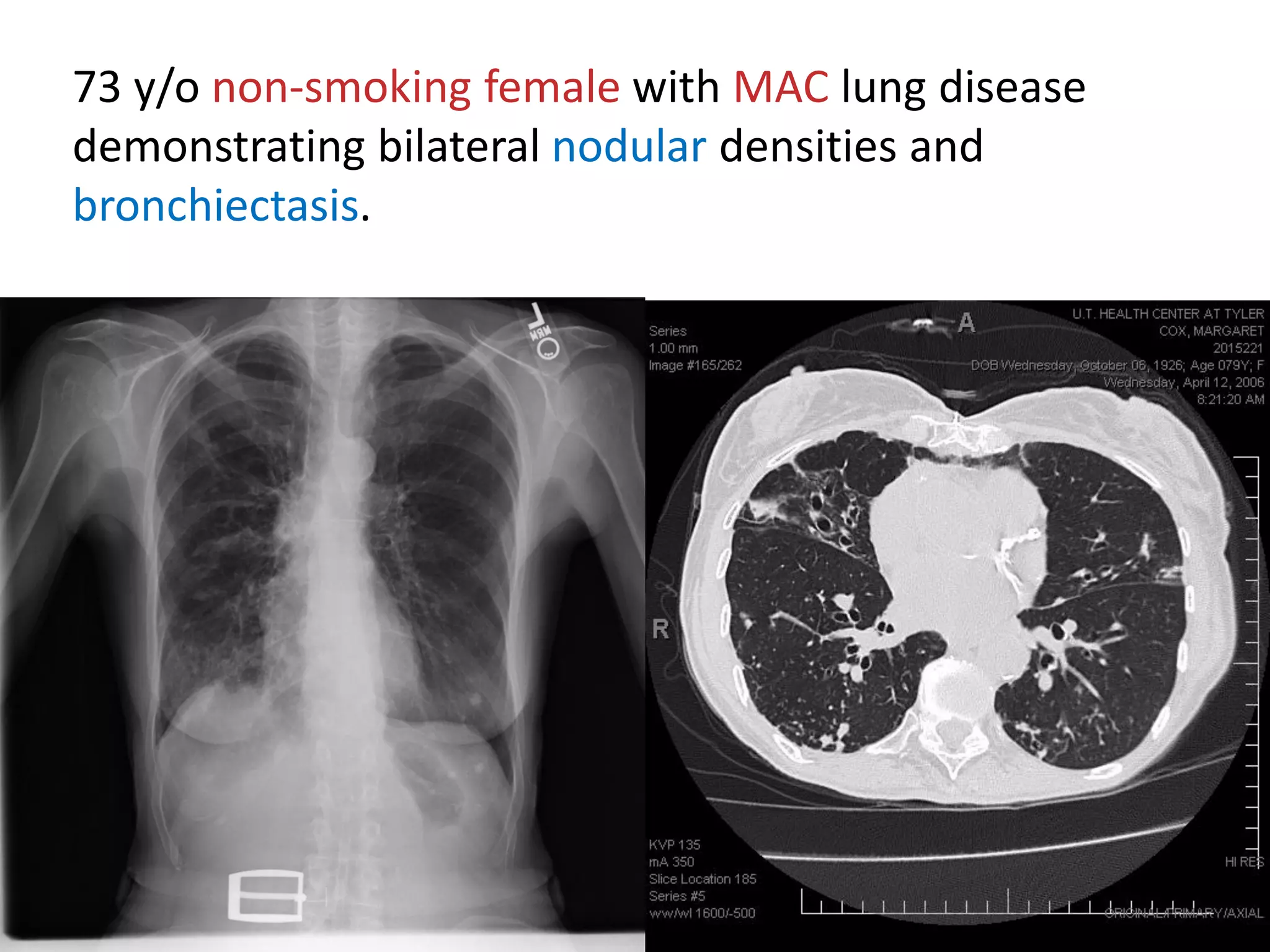 Chest imaging of ntm pulmonary disease2 | PDF
