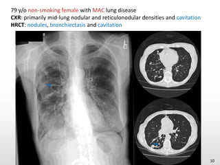 Chest imaging of ntm pulmonary disease2 | PDF