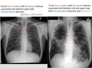 Chest imaging of ntm pulmonary disease2 | PDF