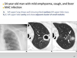 Chest imaging of ntm pulmonary disease2 | PDF