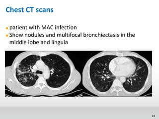 Chest imaging of ntm pulmonary disease2 | PDF