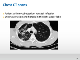 Chest imaging of ntm pulmonary disease2 | PDF