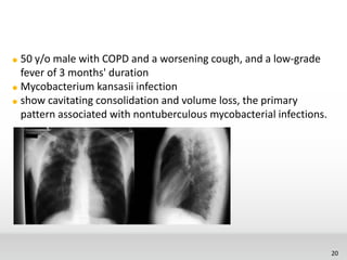 Chest imaging of ntm pulmonary disease2 | PPT