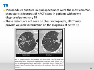 Chest imaging of ntm pulmonary disease2 | PPT