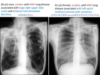 Chest imaging of ntm pulmonary disease2 | PPT