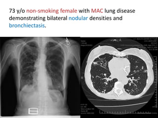 Chest imaging of ntm pulmonary disease2 | PPT