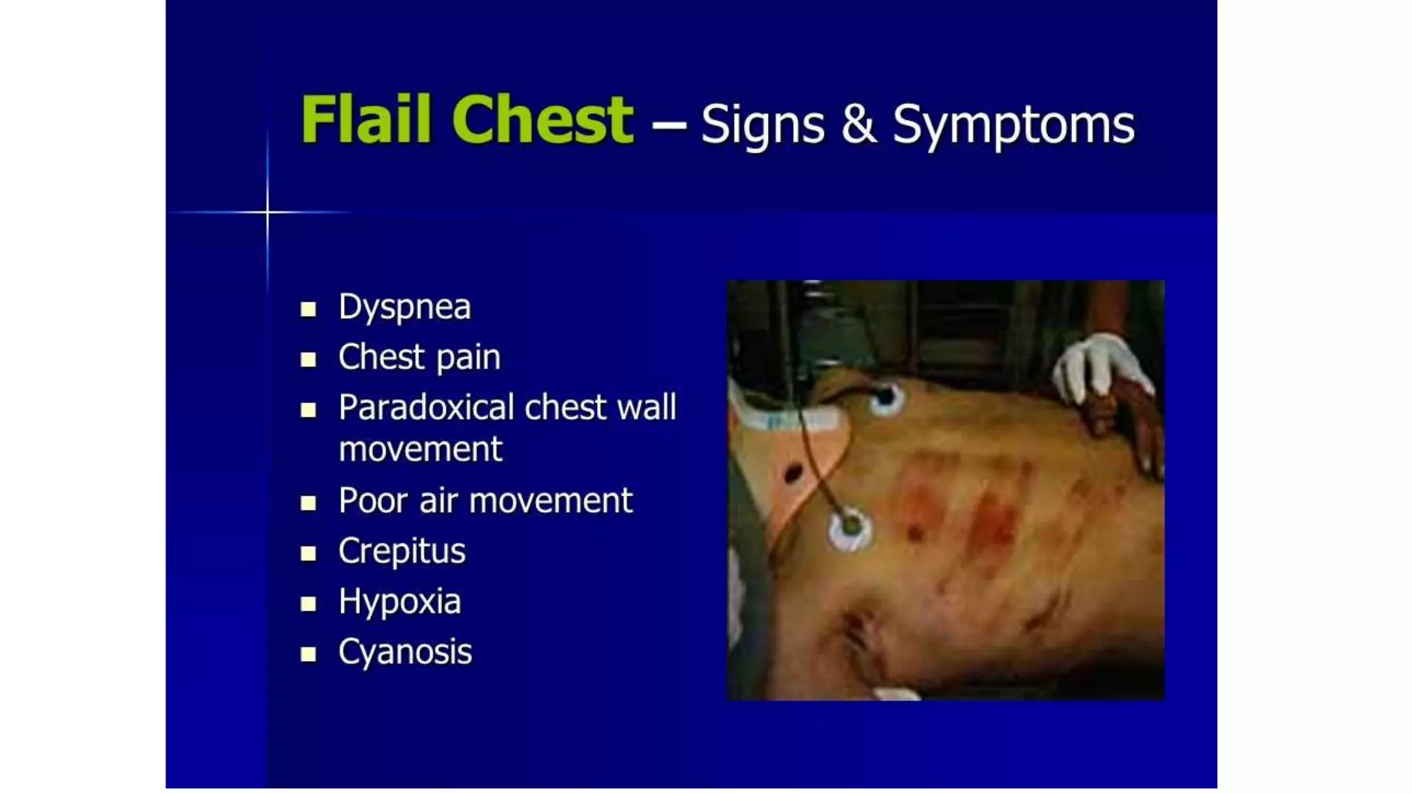 Chest Injuries.pptx