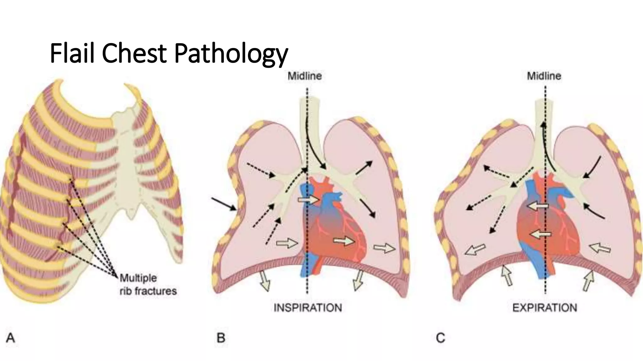 Chest Injuries.pptx