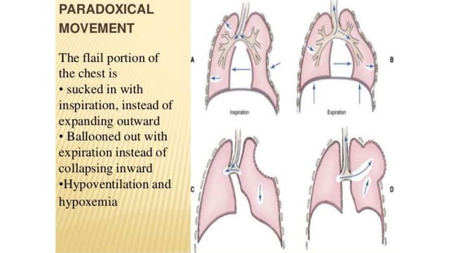 Chest Injuries.pptx
